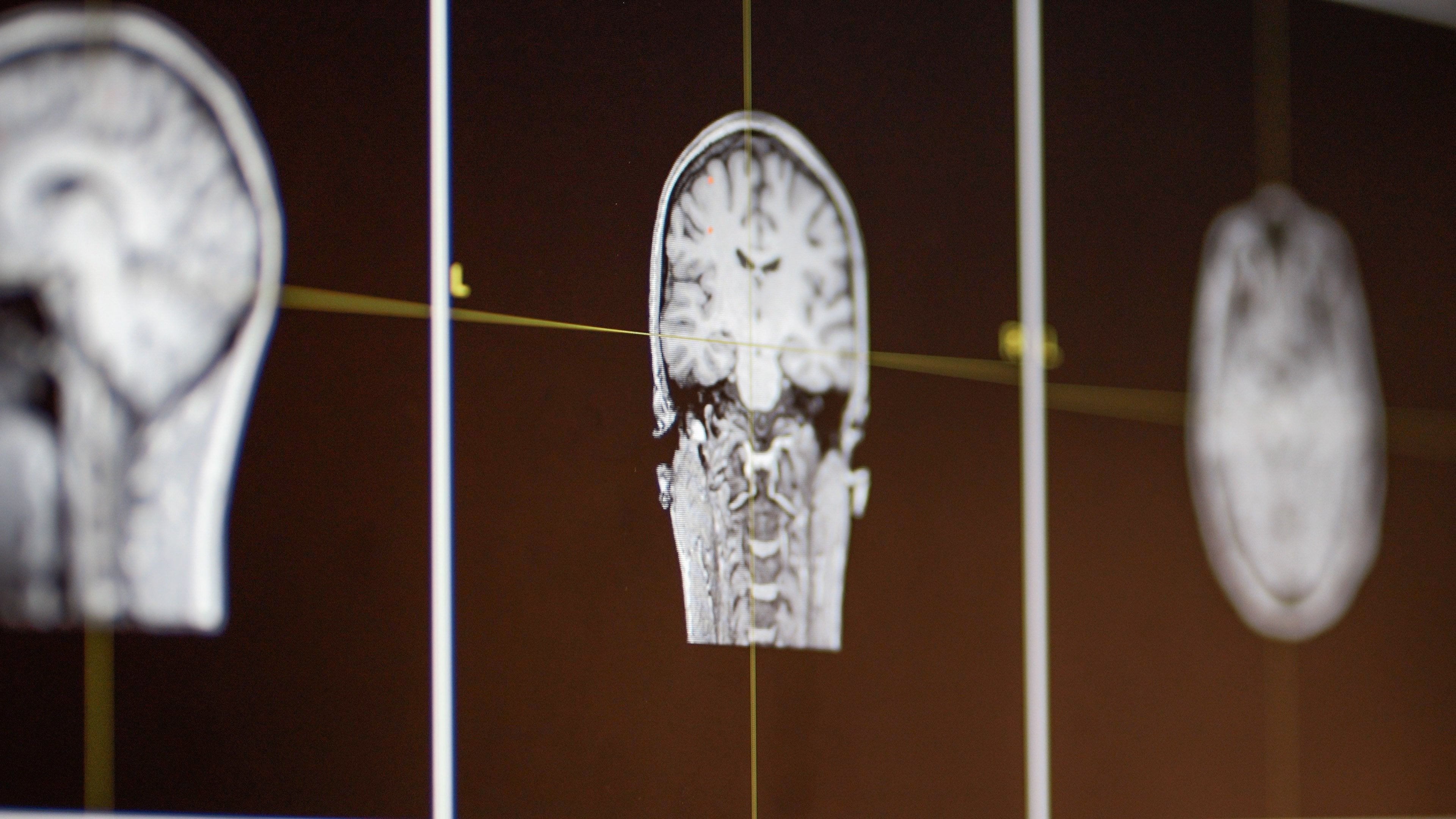 Transcranial Magnetic Stimulation (TMS) Clinic at Butler Hospital